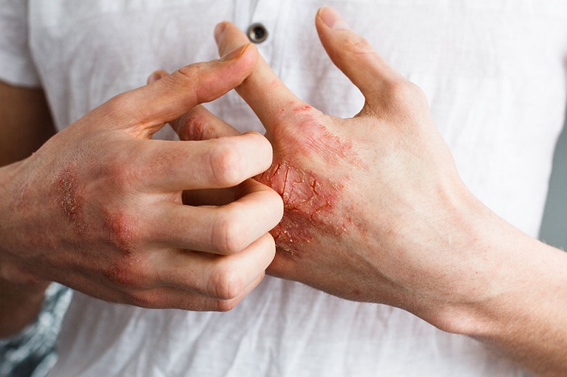 Diabetes Skin Care Tips - DHealthWellness - Everything About Health ...